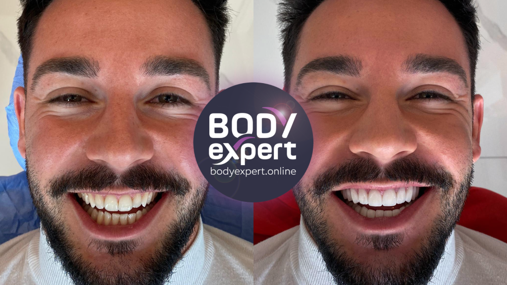 9 types of veneers (pros and cons) | Body Expert