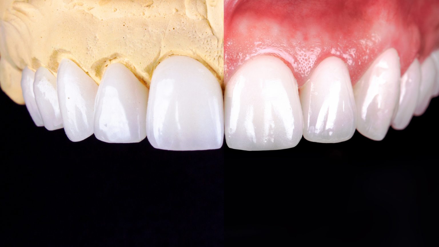 Composite veneers: price, brands, durability, and comparison