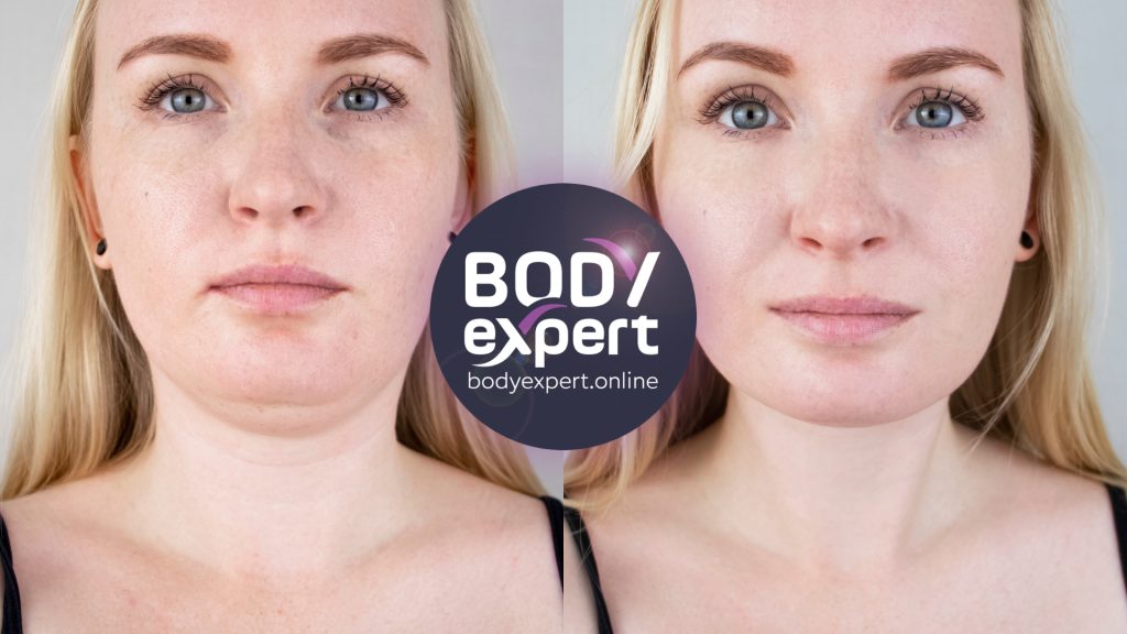 Double chin liposuction in Turkey: cost, procedure, results before and ...