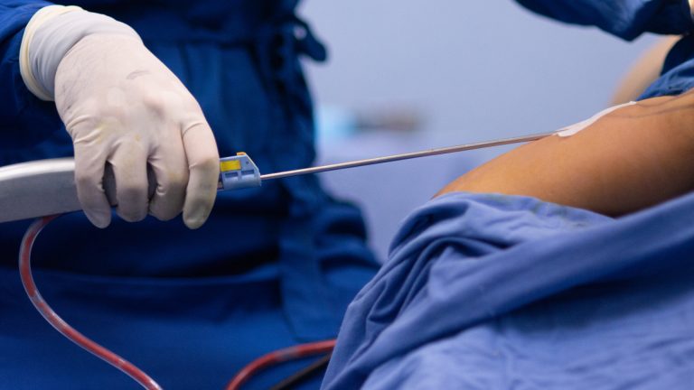 Thigh liposuction: cost procedure, results before and after