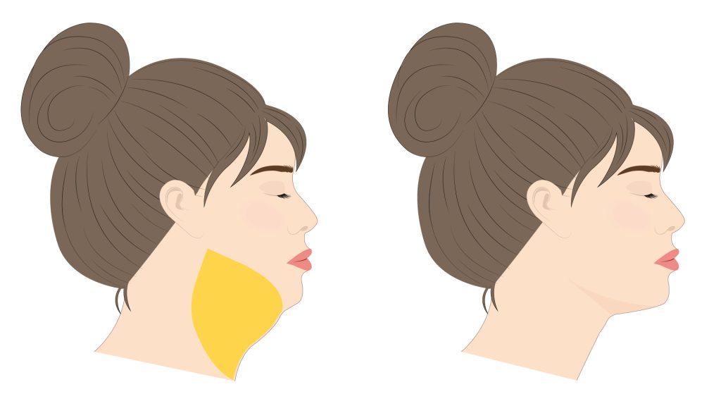 Liposuccion du cou : prix, procédure et résultats avant-après | Body Expert