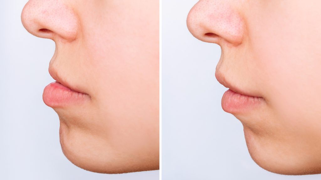 Malocclusion : treatments, types and consequences