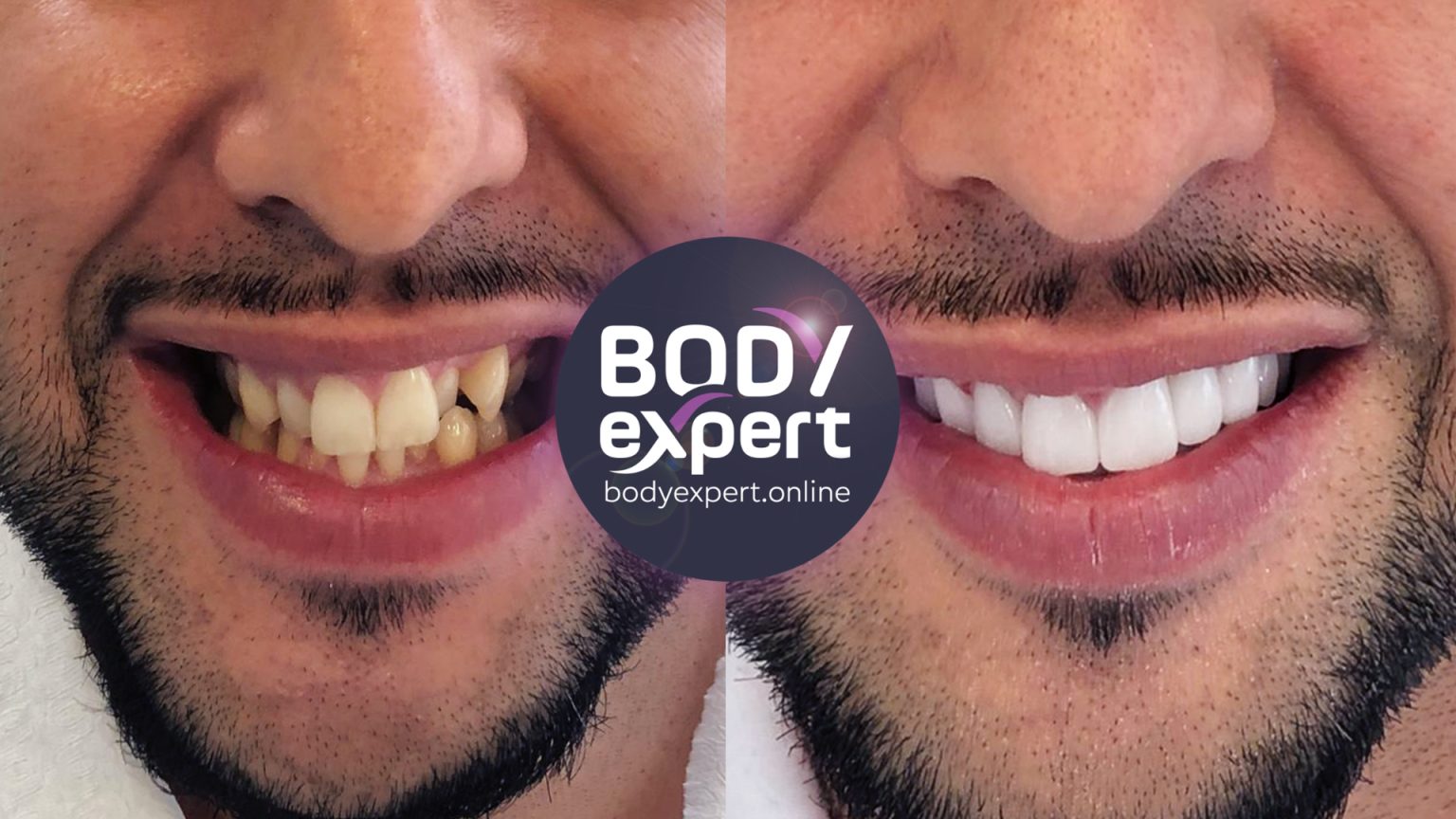 Malocclusion : treatments, types and consequences
