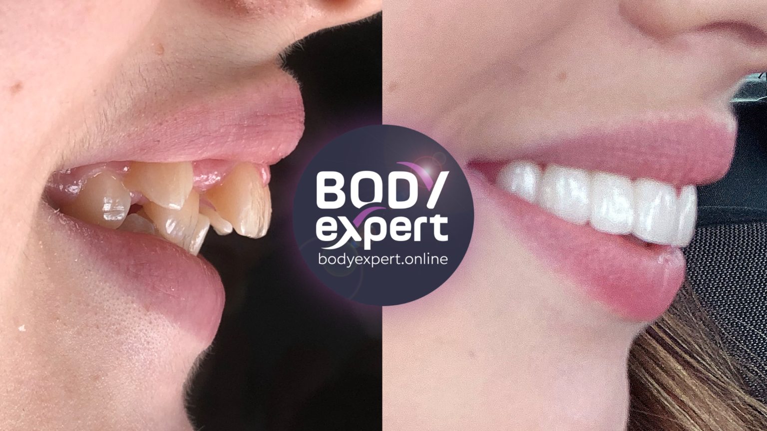 Malocclusion : treatments, types and consequences