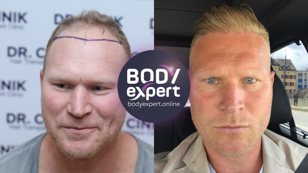 Saphir FUE hair transplant: all about this technique