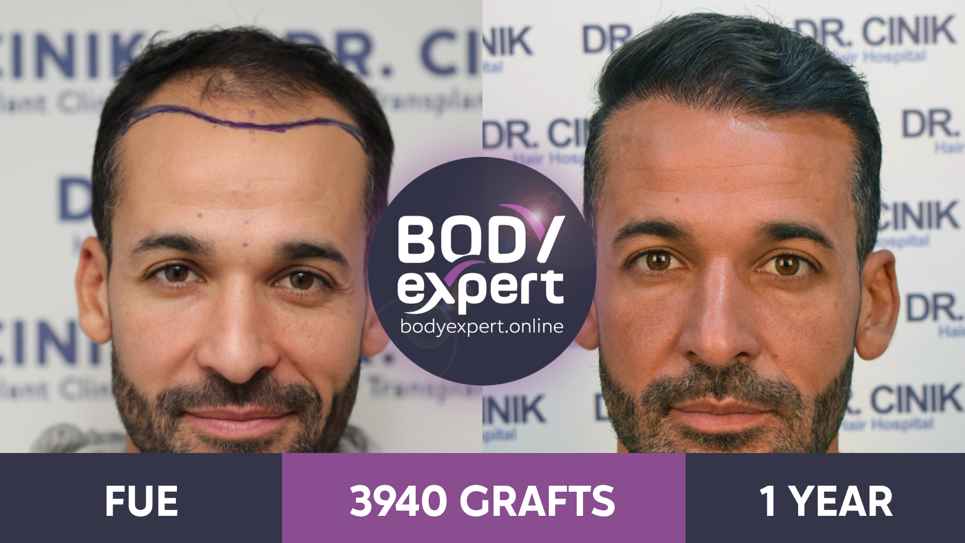 Hair Transplant : before and after photos | Body Expert