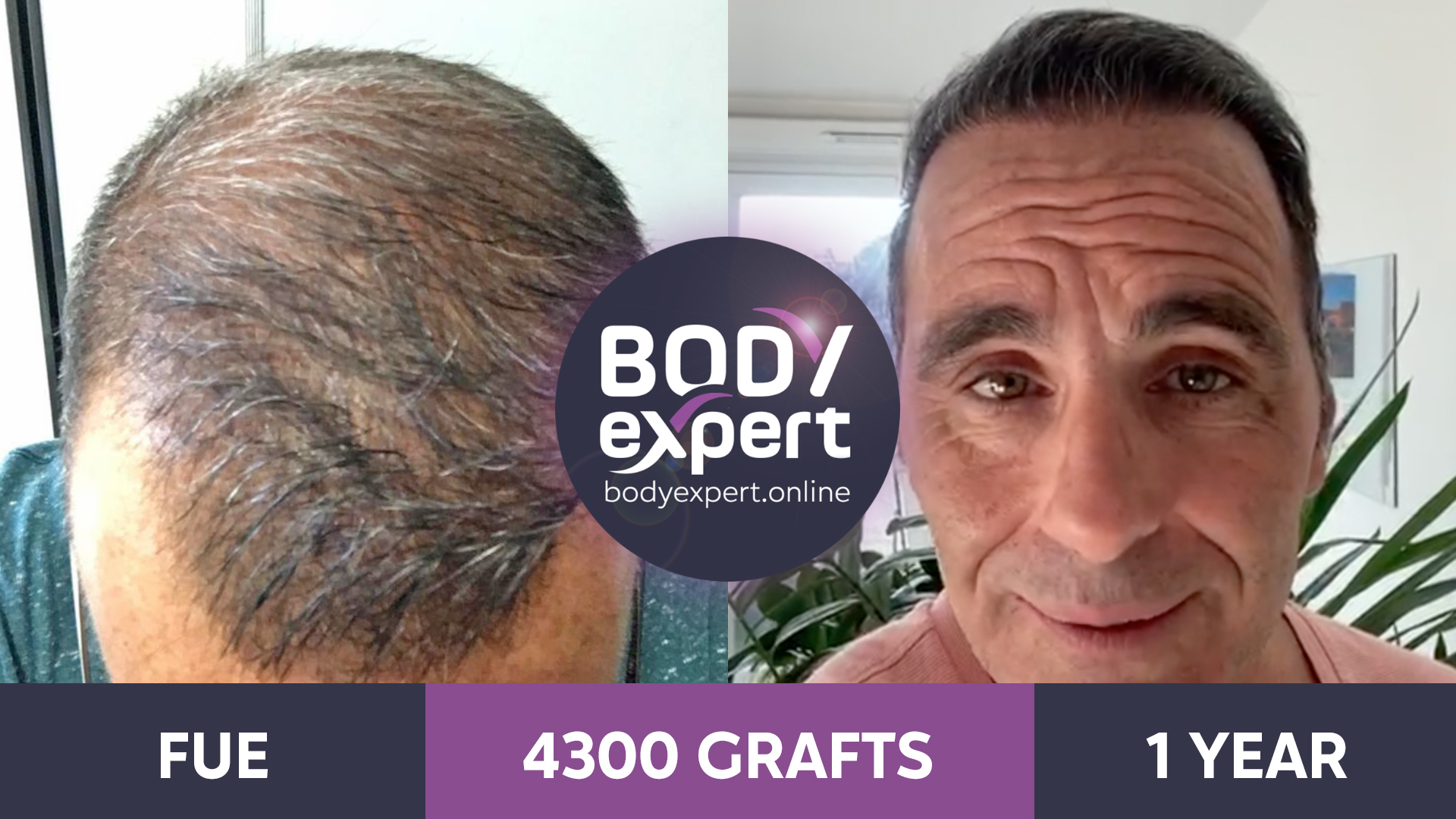 Hair Transplant : before and after photos | Body Expert