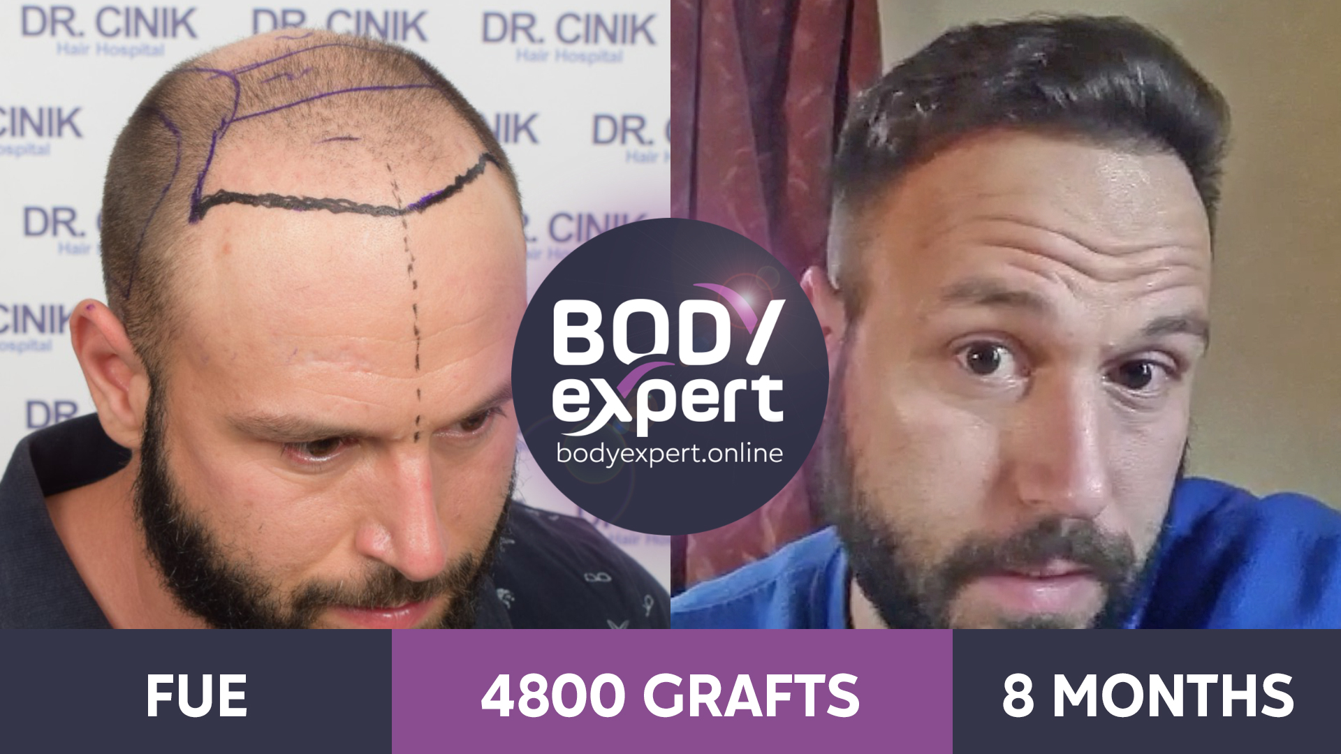 Hair Transplant : before and after photos | Body Expert