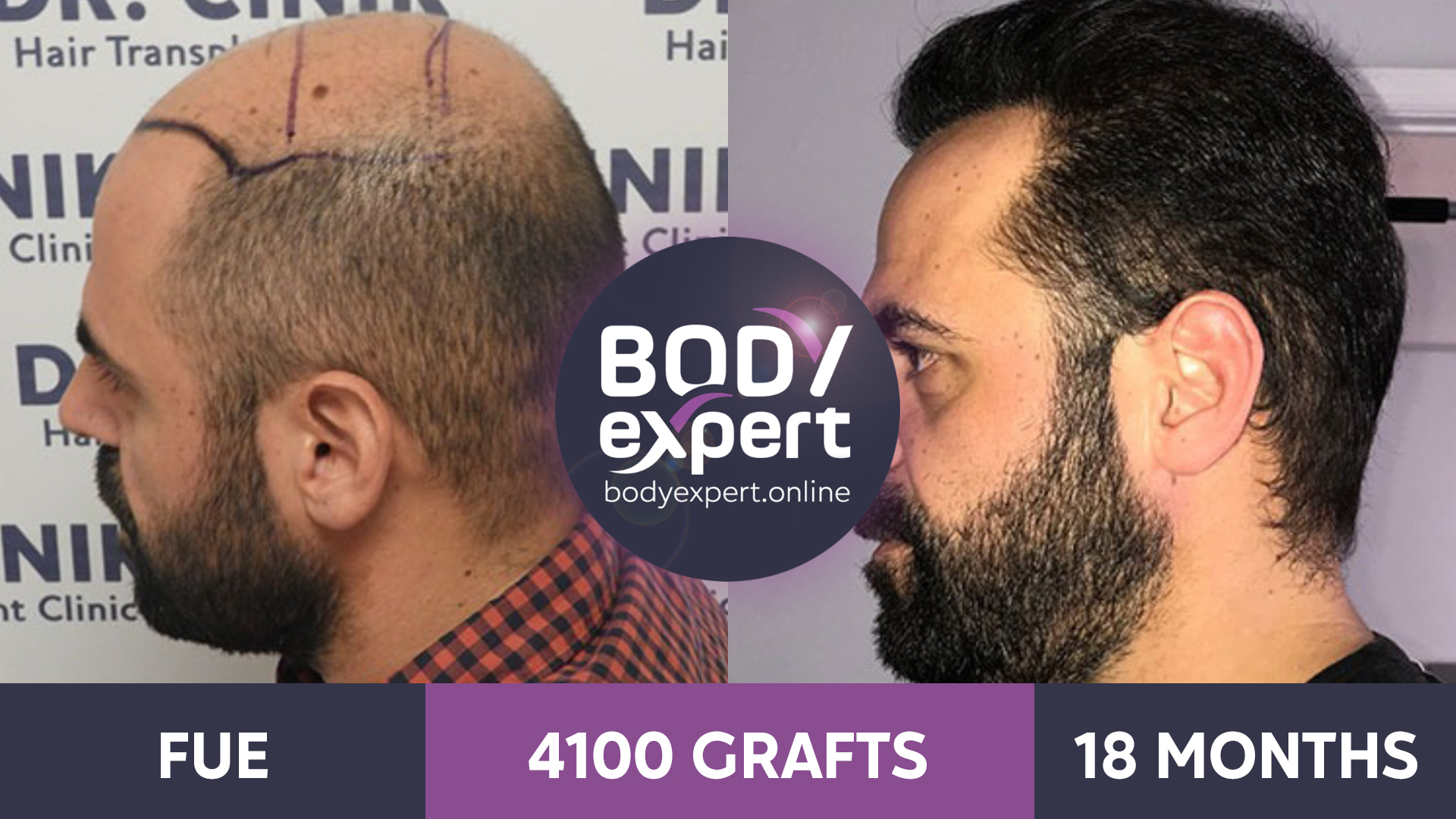 Hair Transplant : before and after photos | Body Expert
