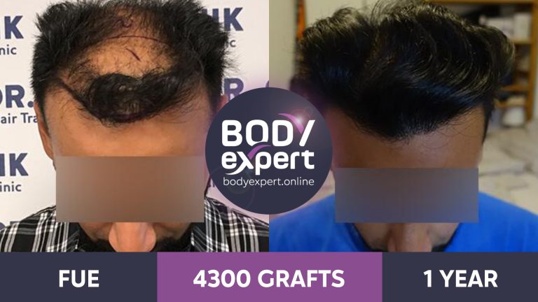 Hair Transplant : before and after photos | Body Expert