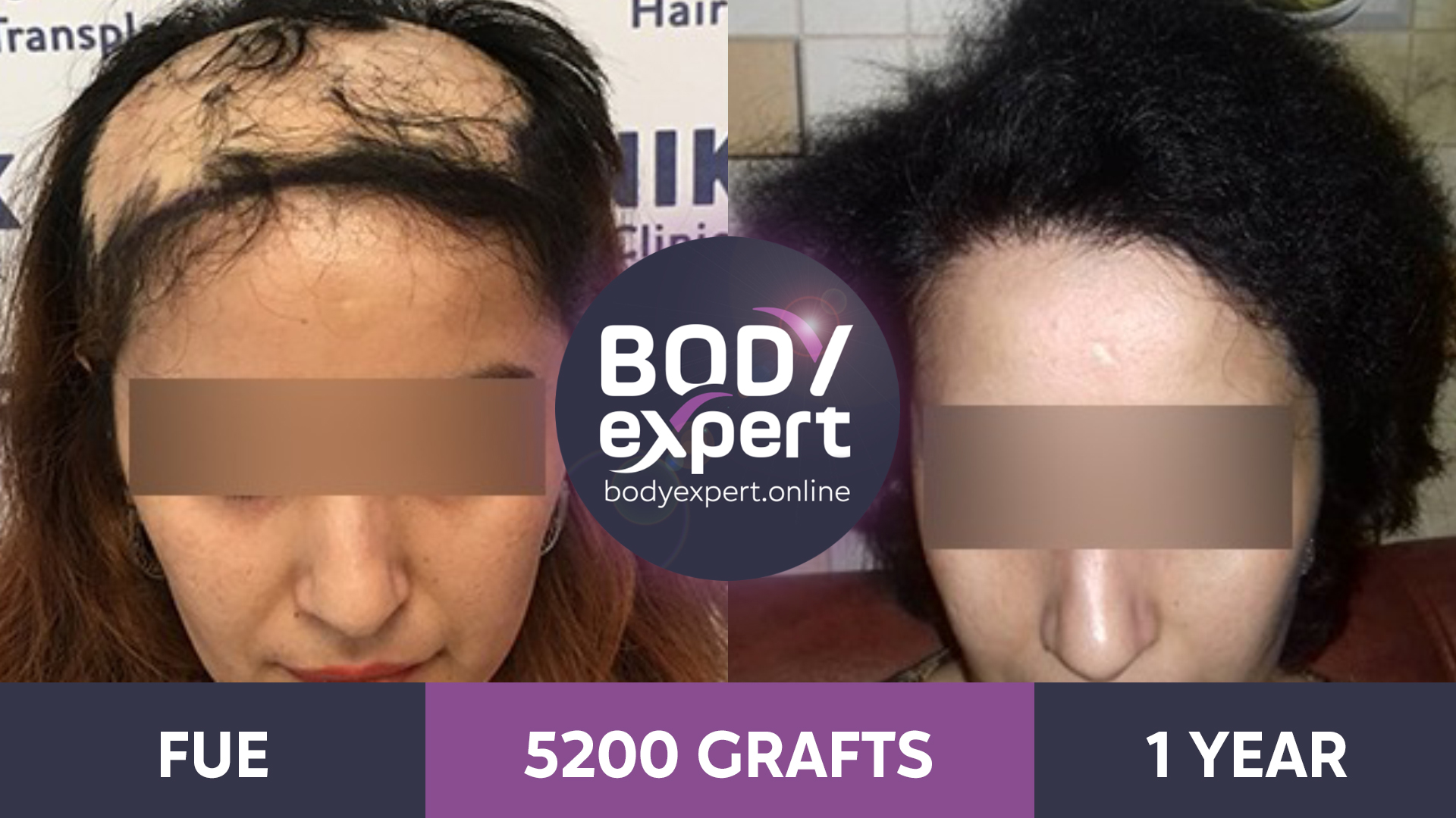 Hair Transplant : before and after photos | Body Expert