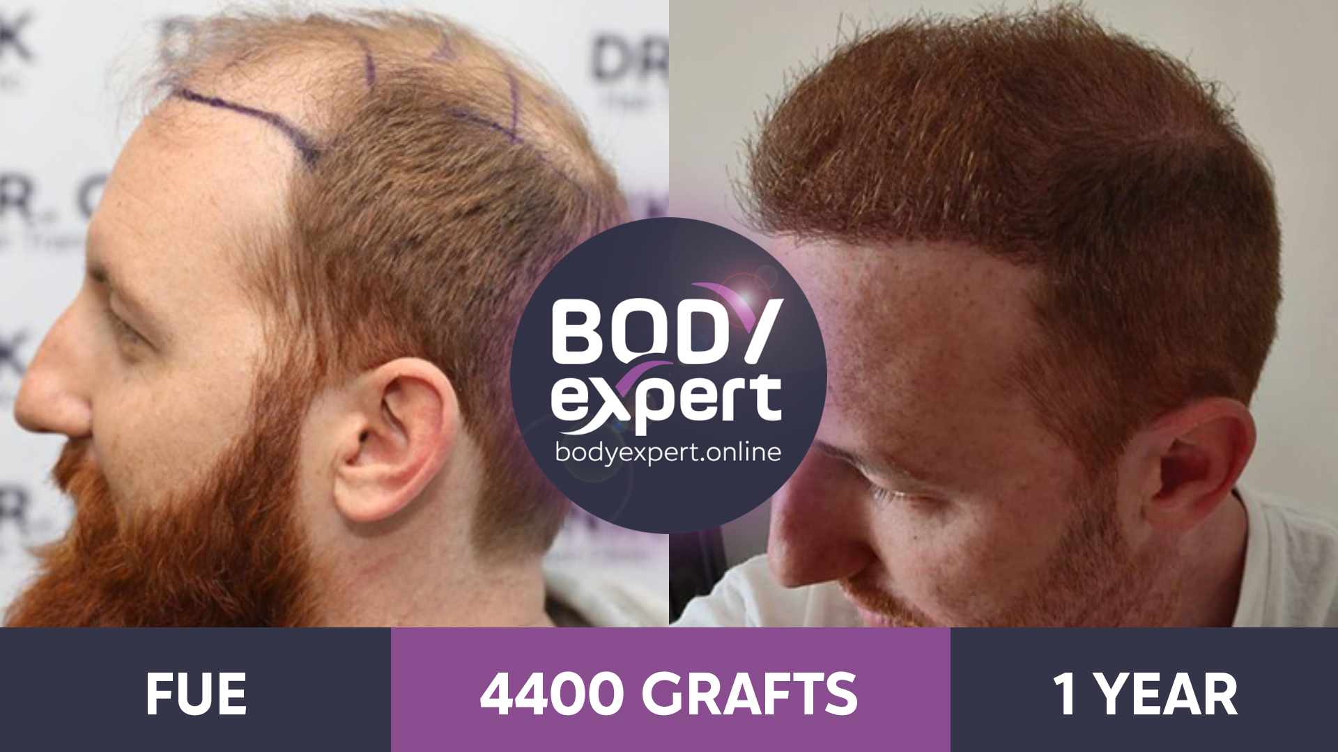 Hair Transplant : before and after photos | Body Expert