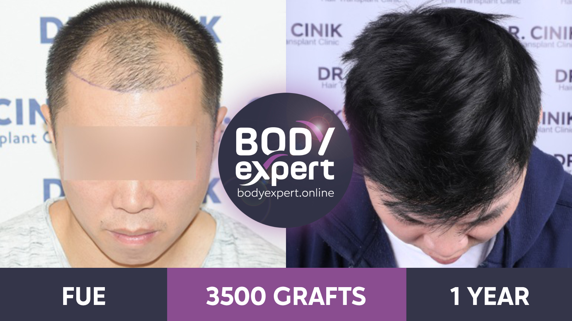 Hair Transplant : before and after photos | Body Expert