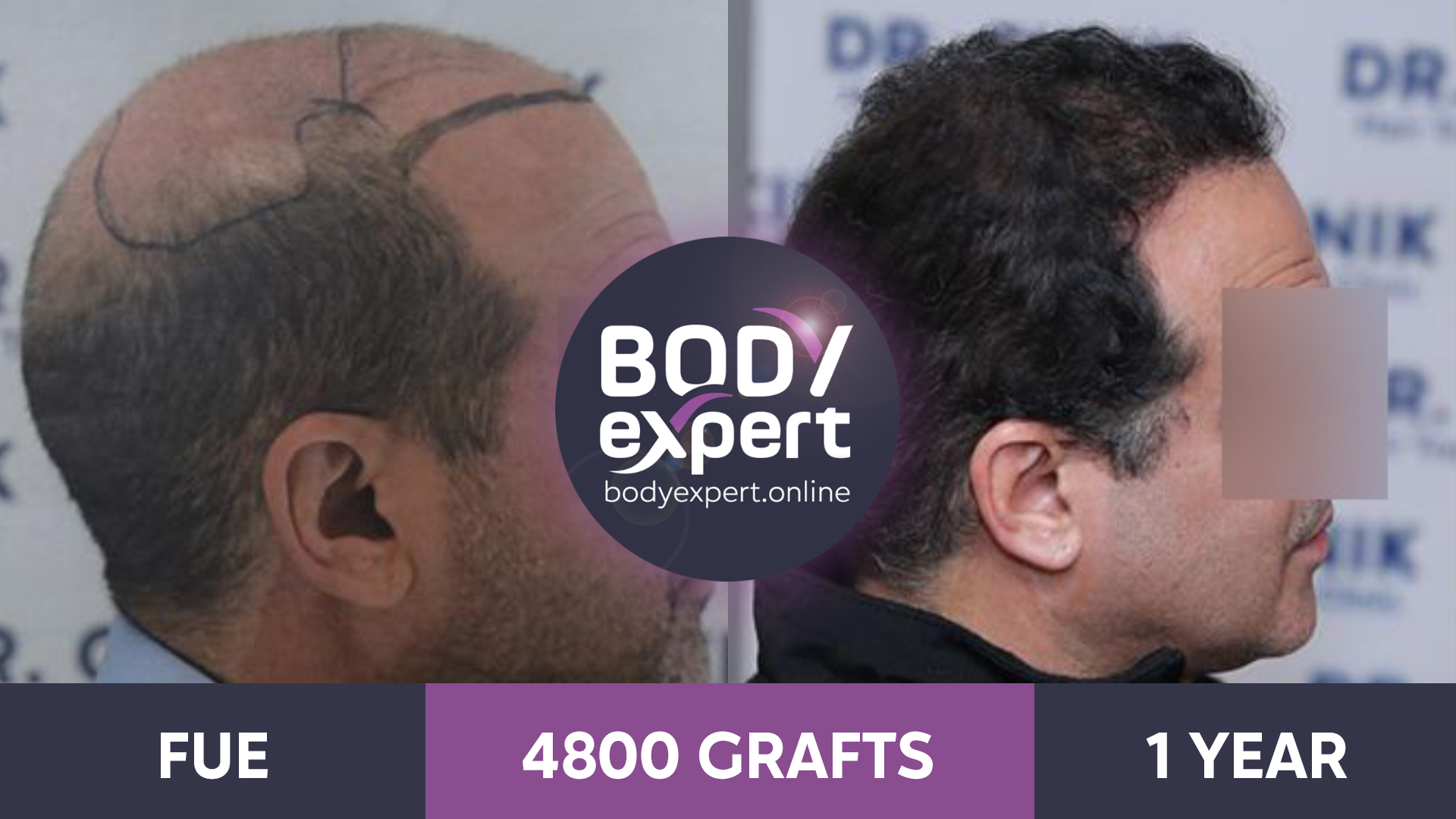 Hair Transplant : before and after photos | Body Expert