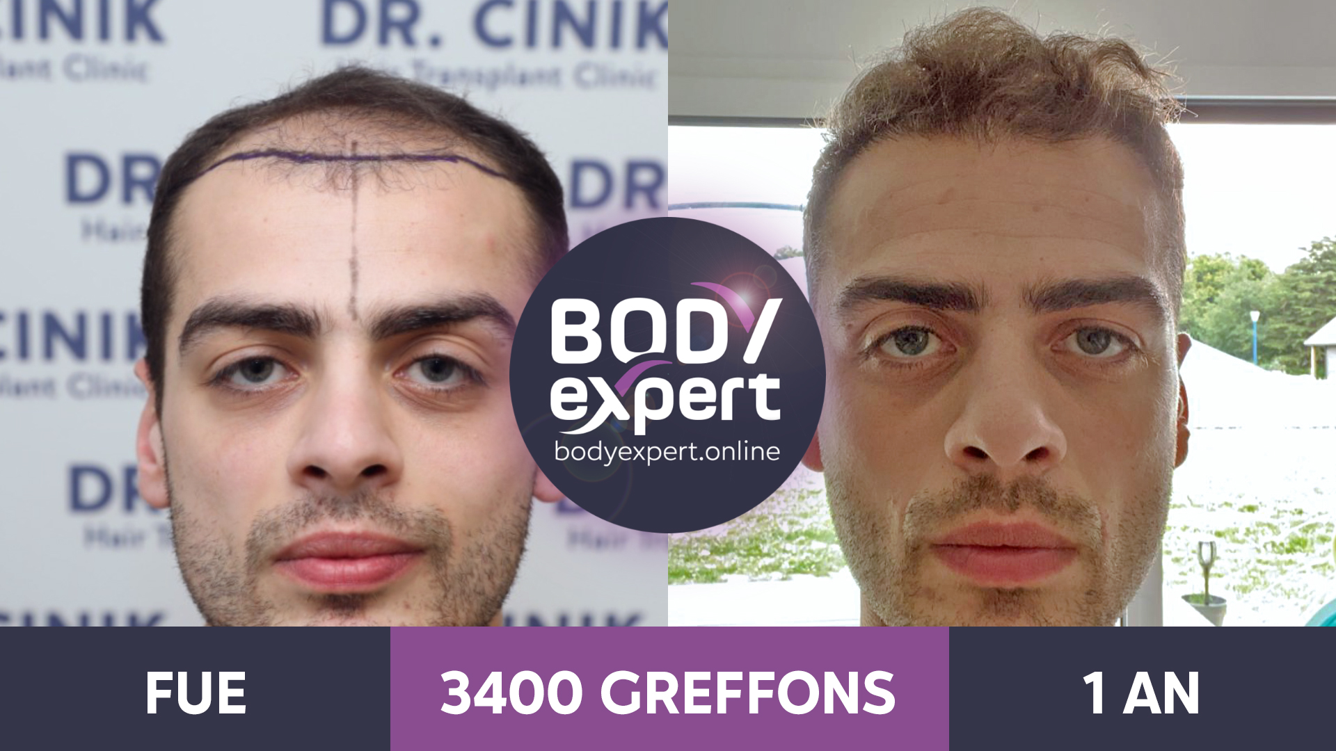 Greffe de cheveux avant - après : les résultats en photos