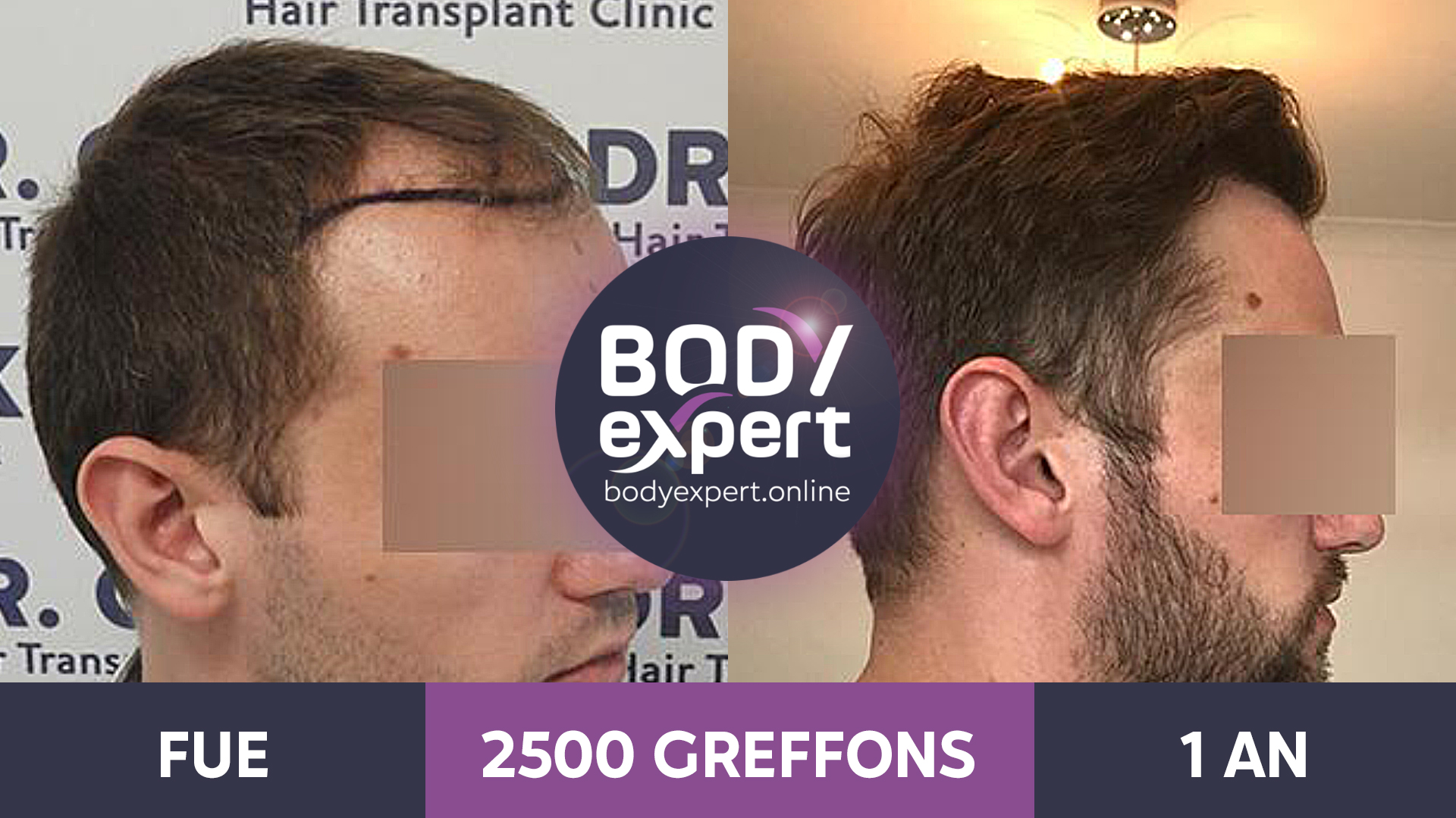 Greffe de cheveux avant - après : les résultats en photos