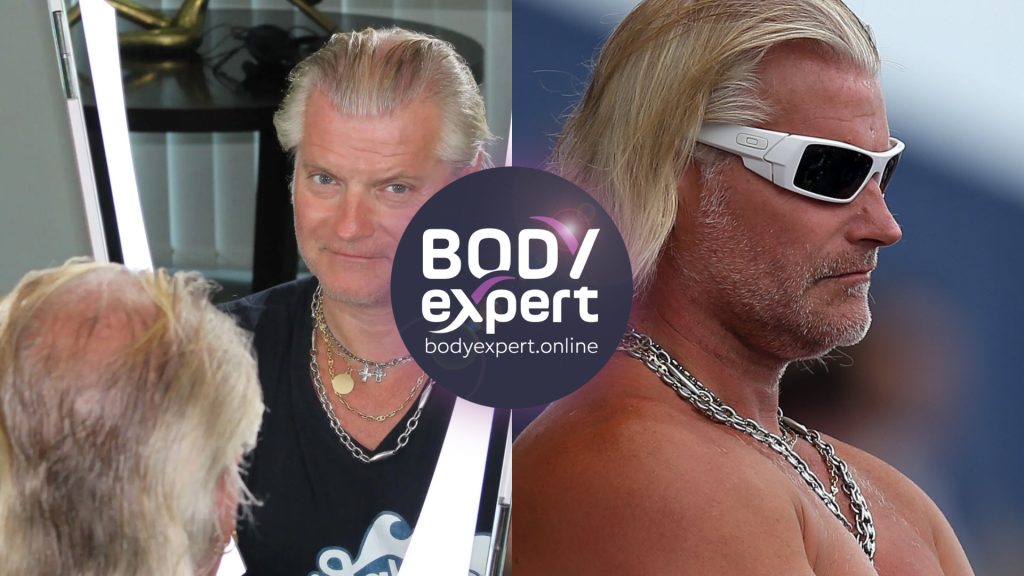 Greffe de cheveux : quelle star a des implants capillaires