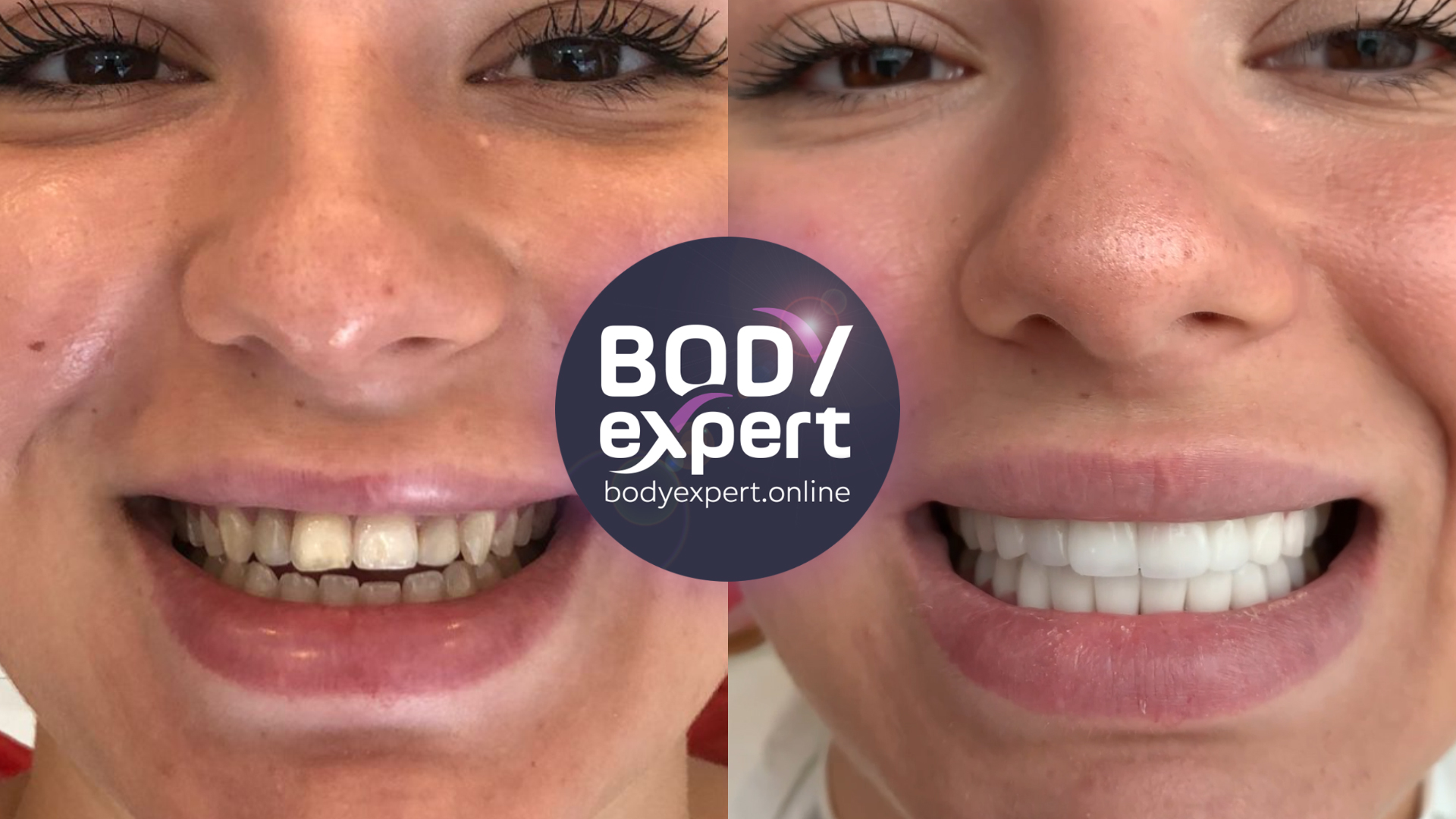 Couronnes dentaire : Avant - Après, résultats après la pose | Body Expert Couronnes dentaire : Avant - Après, résultats après la pose | Body Expert