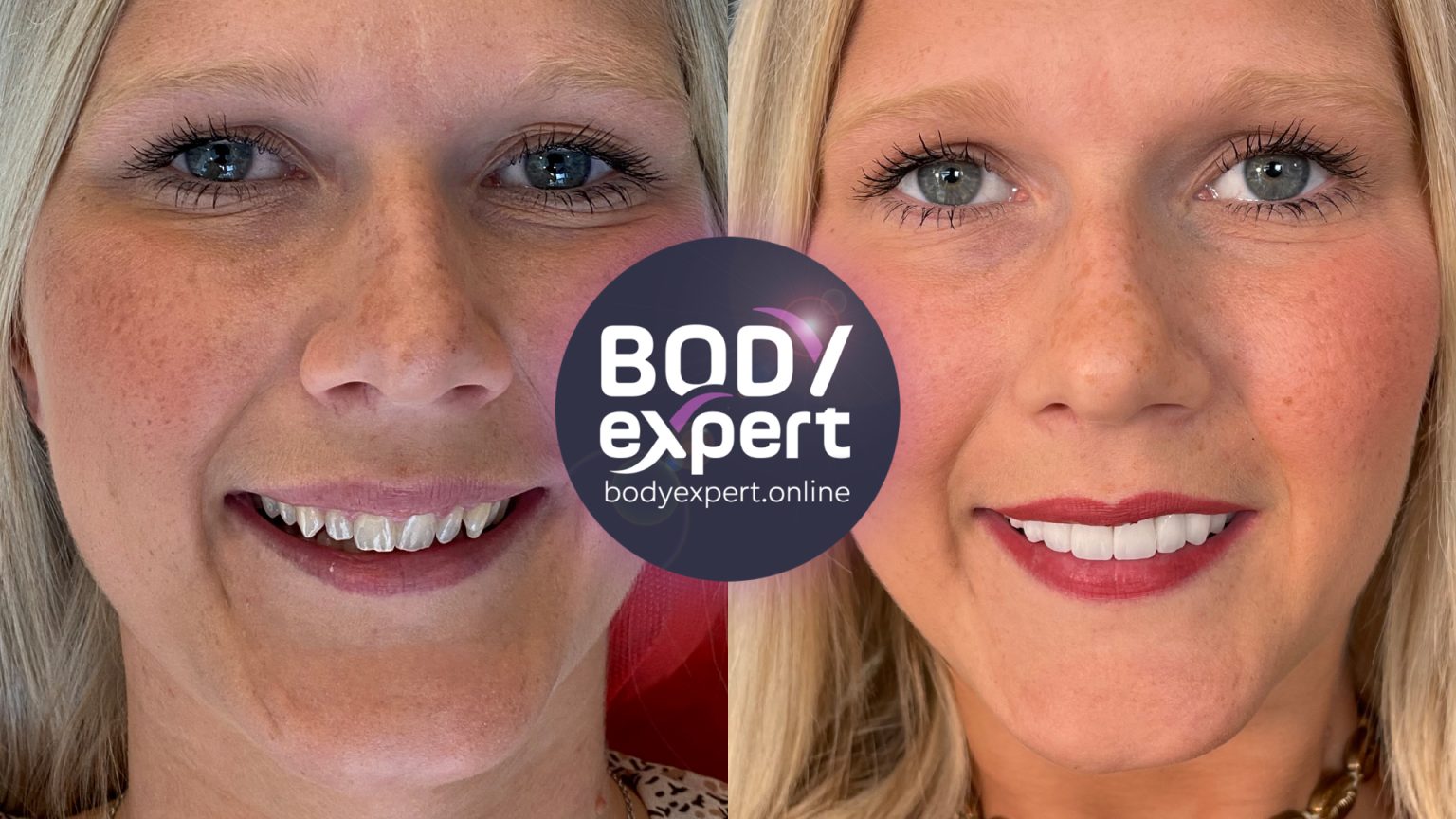 Couronnes dentaire : Avant - Après, résultats après la pose | Body Expert