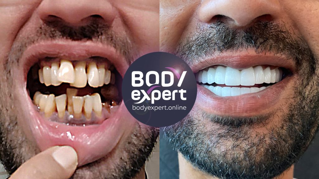 Dentier fixe : tout savoir sur ce type de dispositif