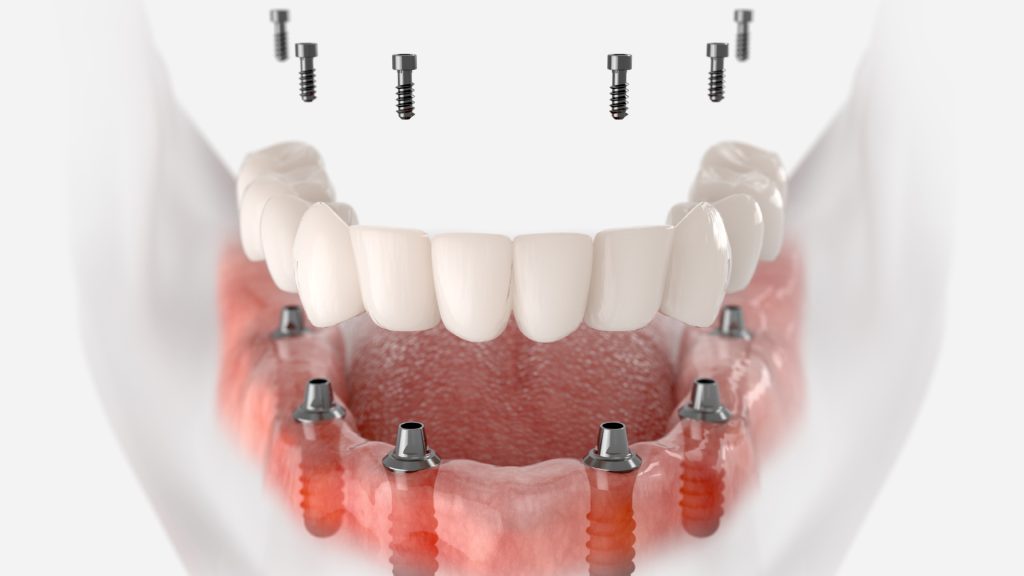 Dental Prostheses : types, prices, NHS coverage - The Complete Guide