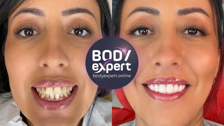 Couronnes dentaire : Avant - Après, résultats après la pose | Body Expert