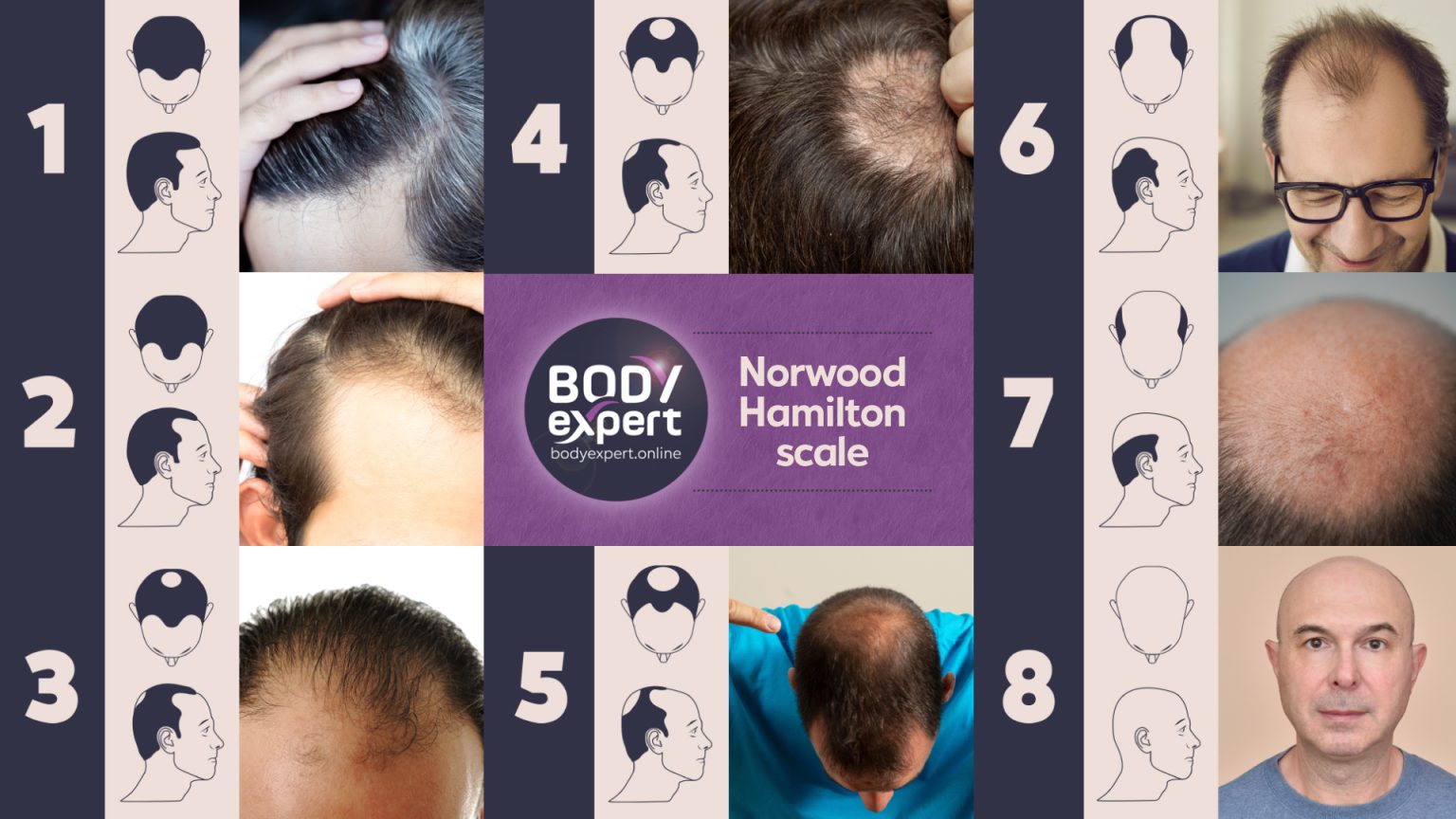 Norwood-Hamilton scale: the 7 stages of male pattern baldness
