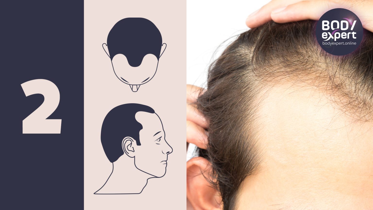 Norwood-Hamilton scale: the 7 stages of male pattern baldness