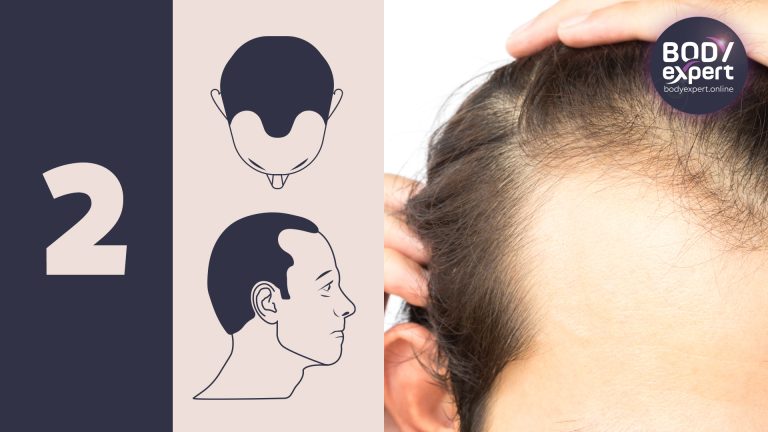 Norwood-Hamilton scale: the 7 stages of male pattern baldness