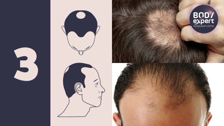 Norwood-Hamilton scale: the 7 stages of male pattern baldness