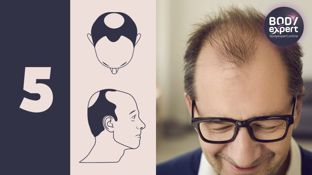 Norwood-Hamilton scale: the 7 stages of male pattern baldness