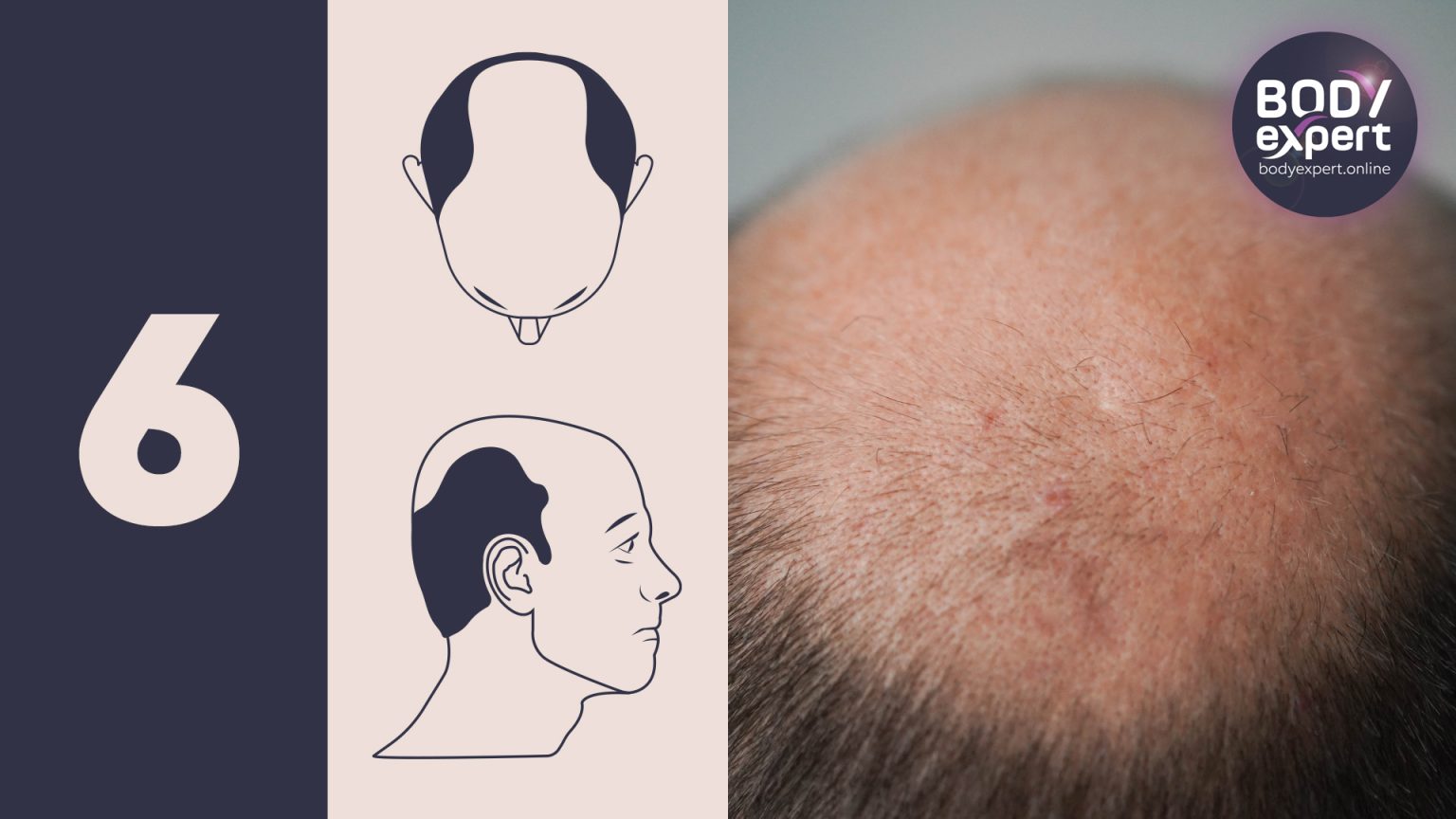 Norwood-Hamilton scale: the 7 stages of male pattern baldness