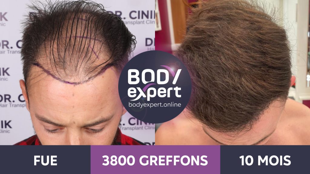 Échelle de Norwood-Hamilton : les 7 stades de la calvitie masculine