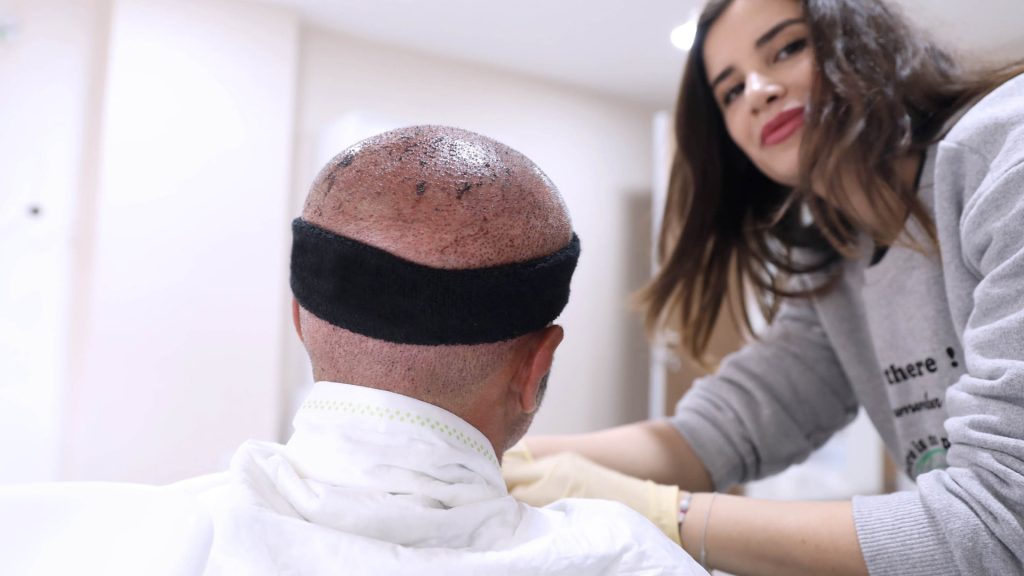 Alopécie : définition, causes, symptômes, types et traitements