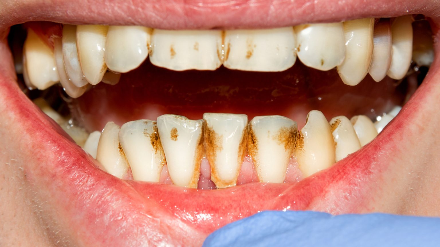 Refaire Ses dents : Les solutions possibles et leurs prix | Body Expert