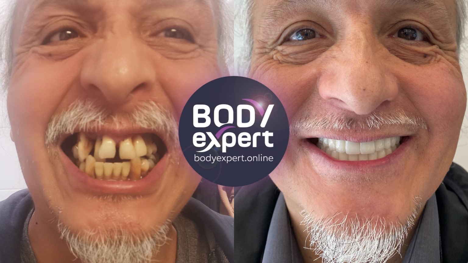 Refaire Ses dents : Les solutions possibles et leurs prix | Body Expert