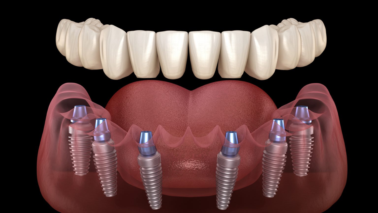 All-On 4: Everything you need to know about All-On 4 dental system