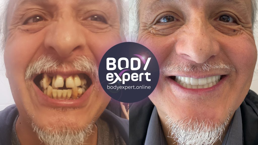 All-On 4: Everything you need to know about All-On 4 dental system