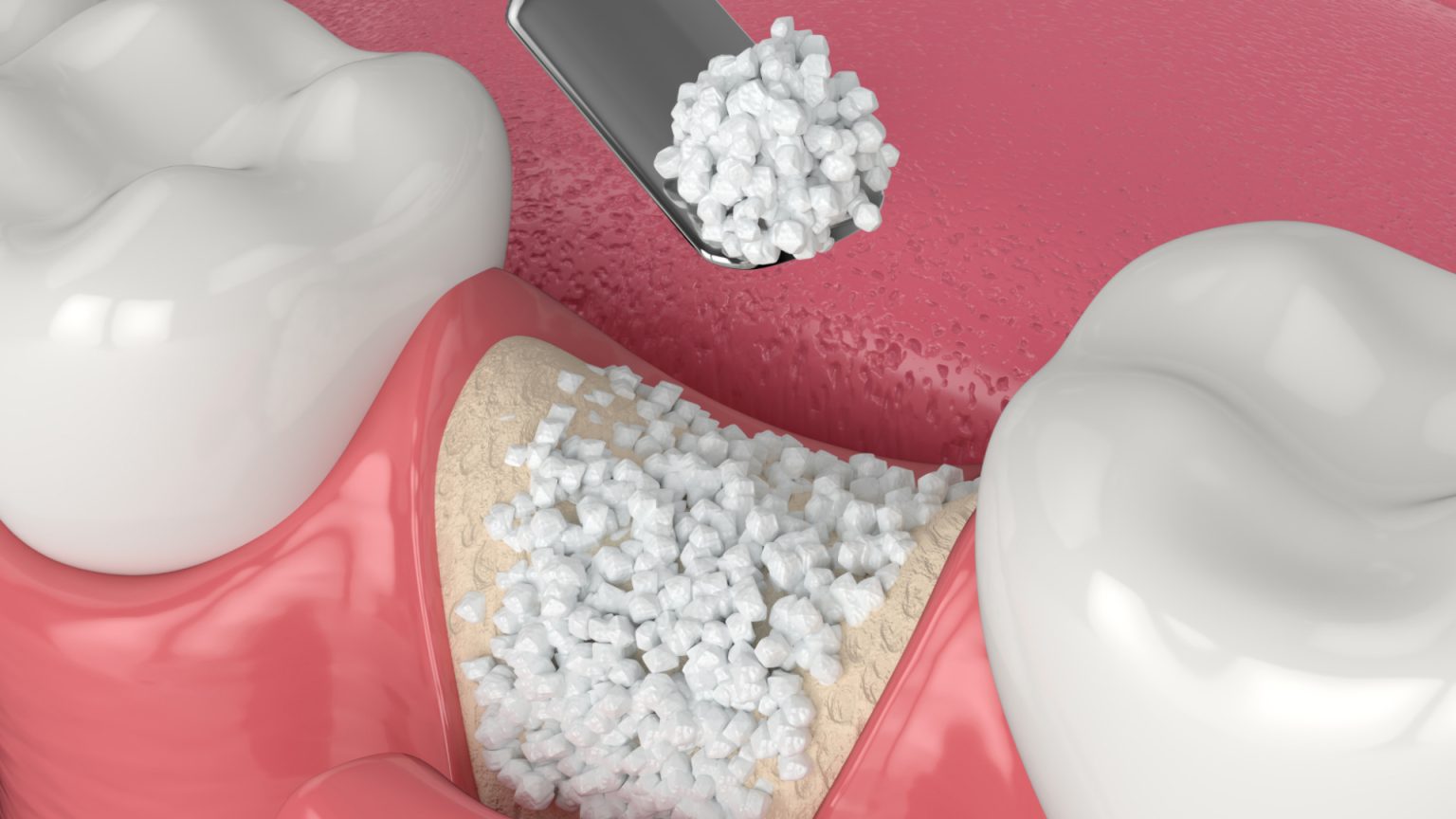 Refaire Ses dents : Les solutions possibles et leurs prix | Body Expert