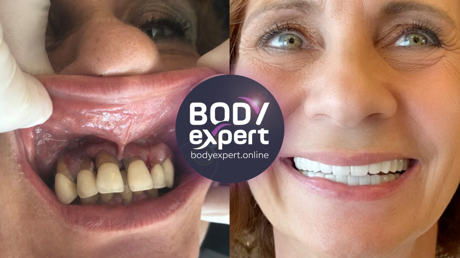 Refaire Ses dents : Les solutions possibles et leurs prix | Body Expert