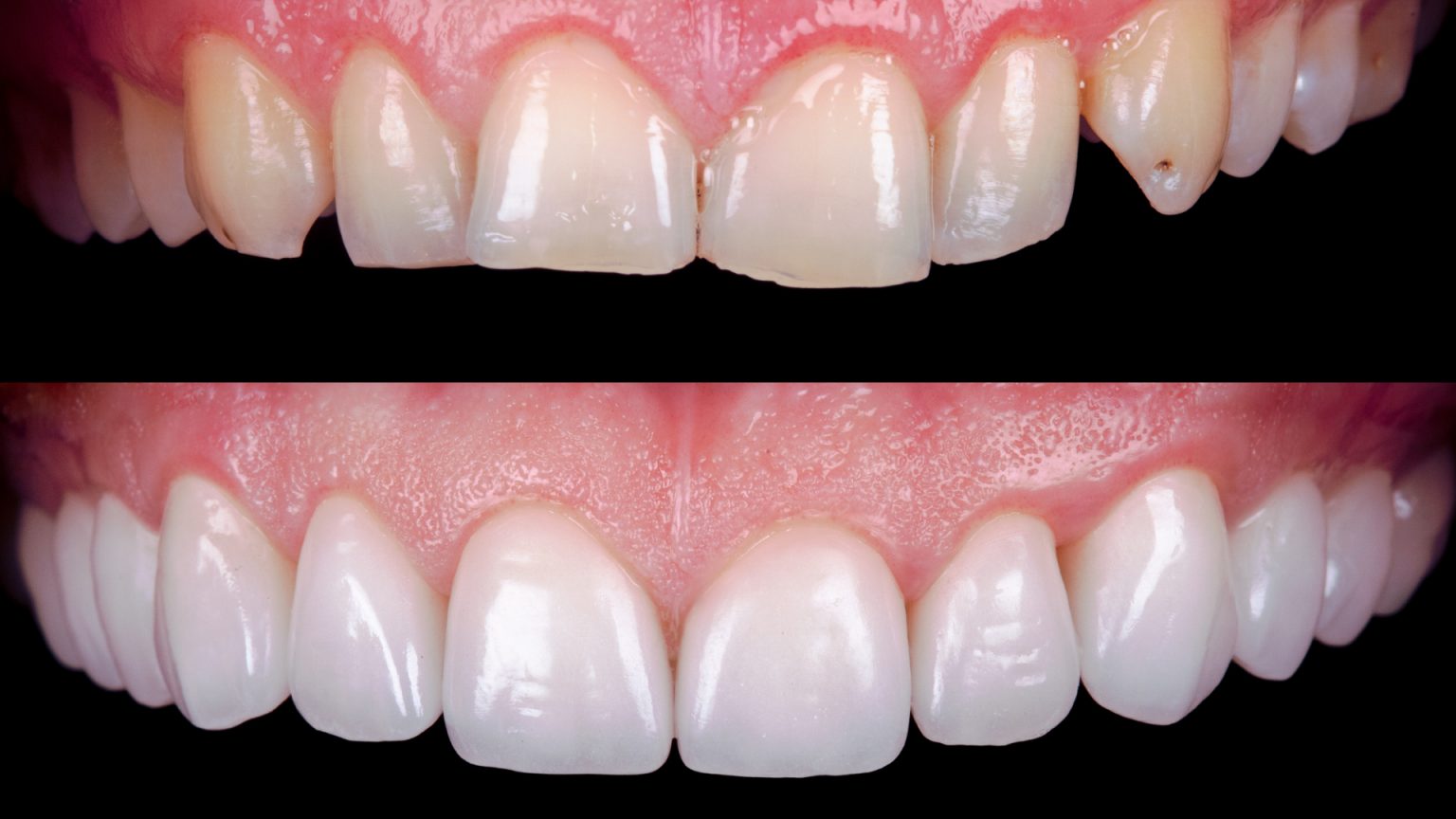 Refaire Ses dents : Les solutions possibles et leurs prix.