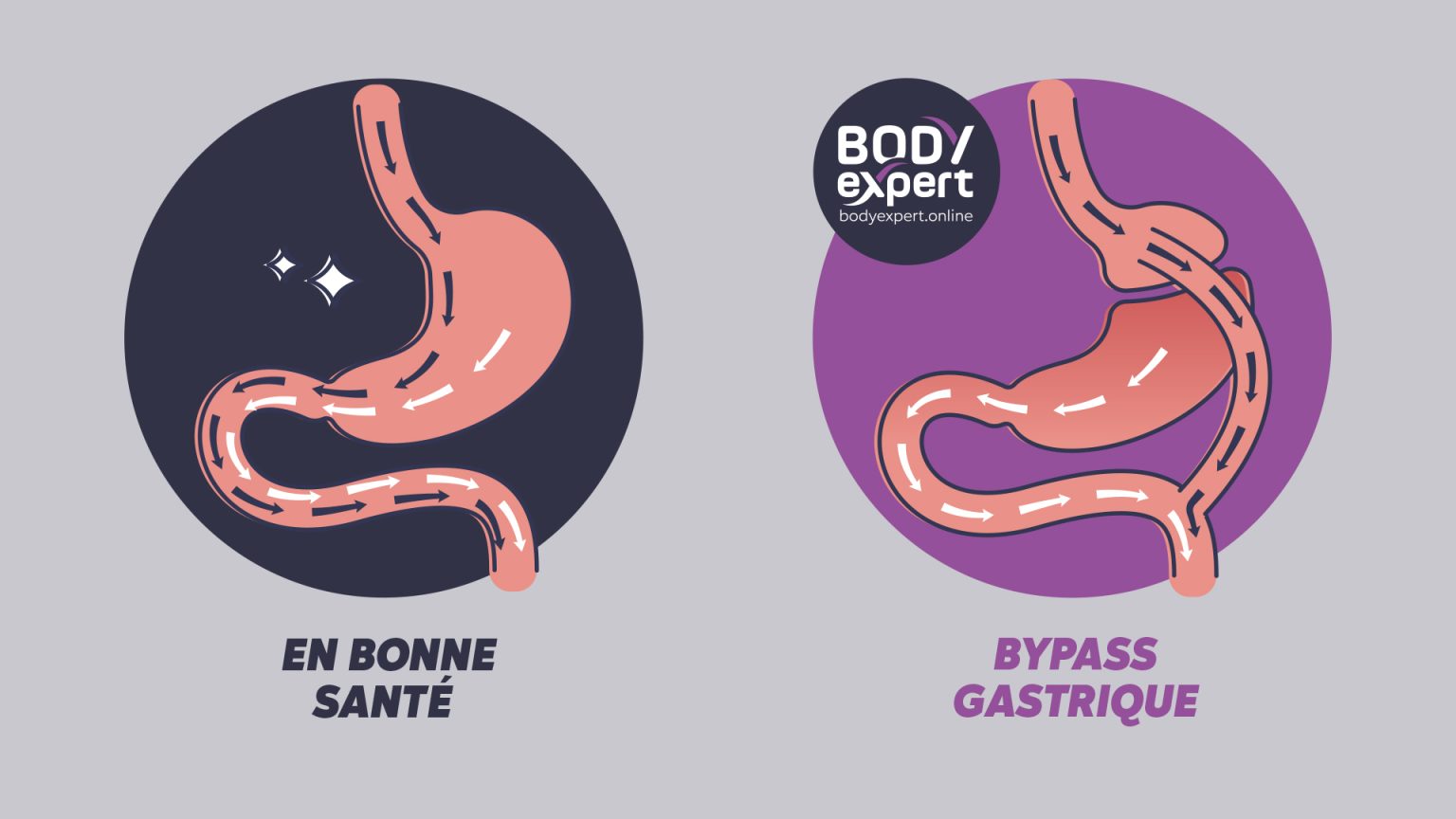 Sleeve vs Bypass : quelle intervention choisir