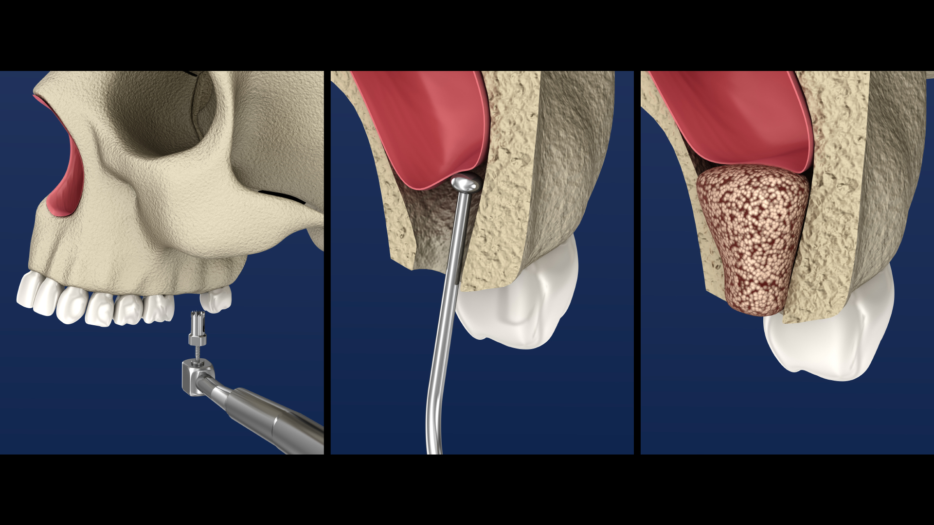 Sinus Lift: Explanation, Procedure and Alternatives in Dental Implantology | Body Expert