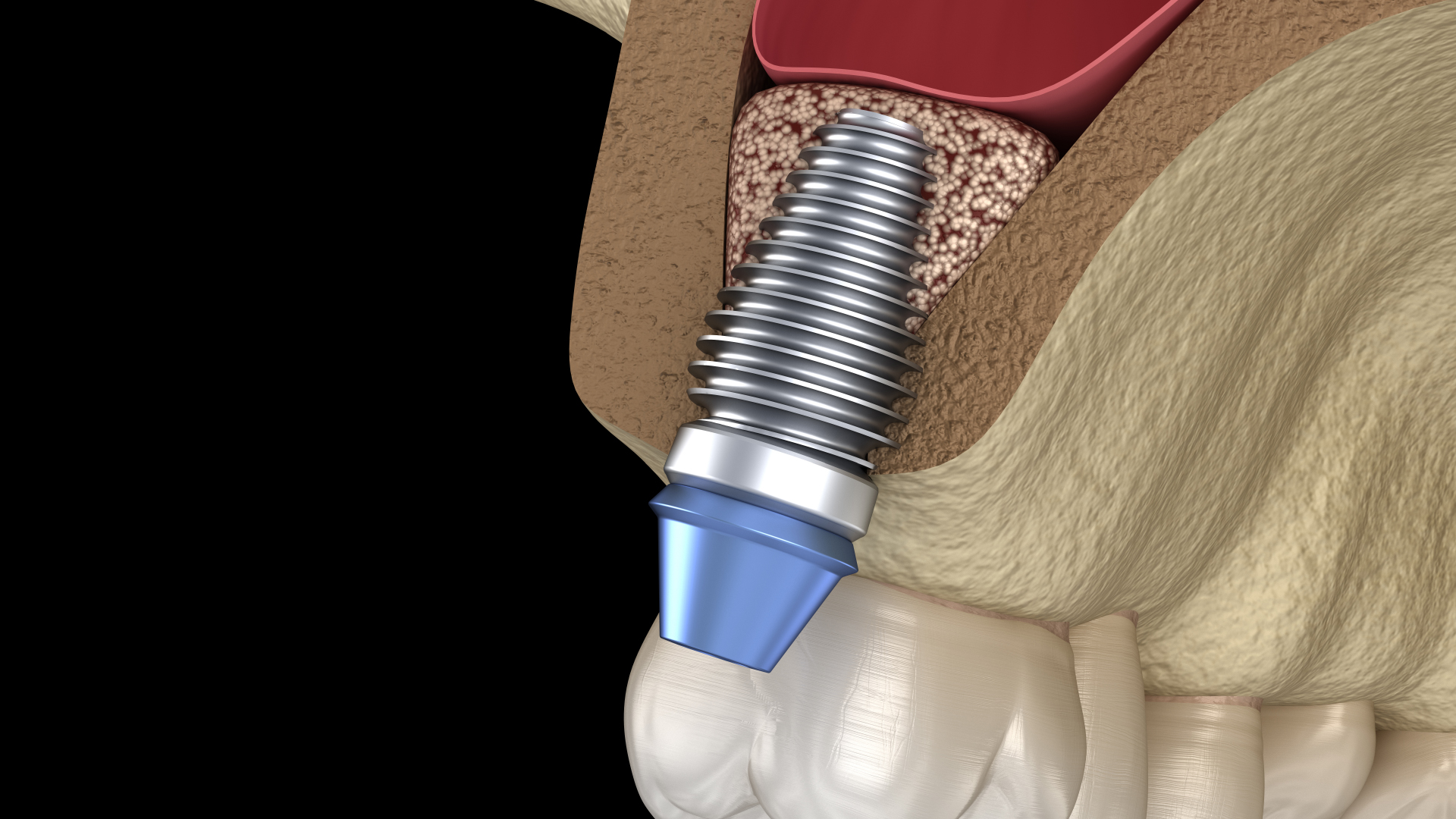 Sinus Lift: Explanation, Procedure and Alternatives in Dental Implantology | Body Expert