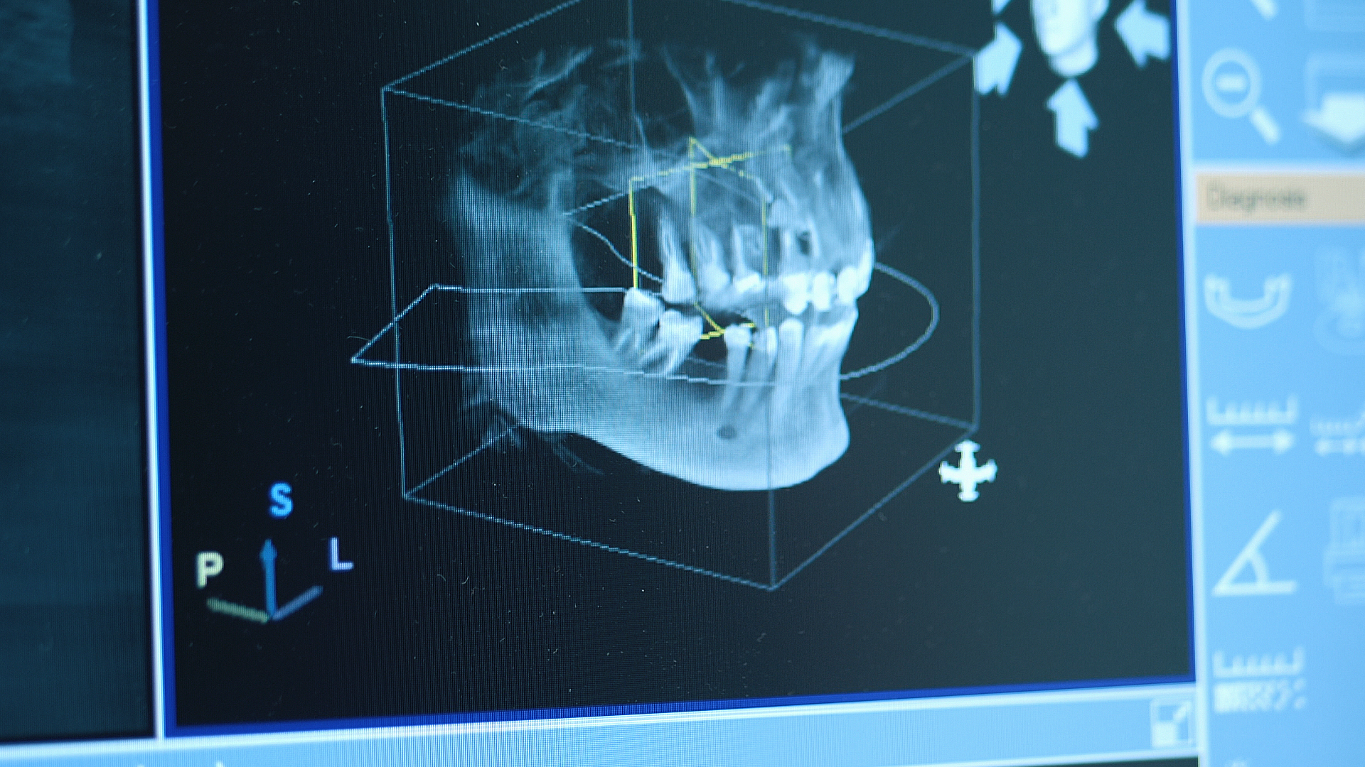 Sinus Lift: Explanation, Procedure and Alternatives in Dental ...