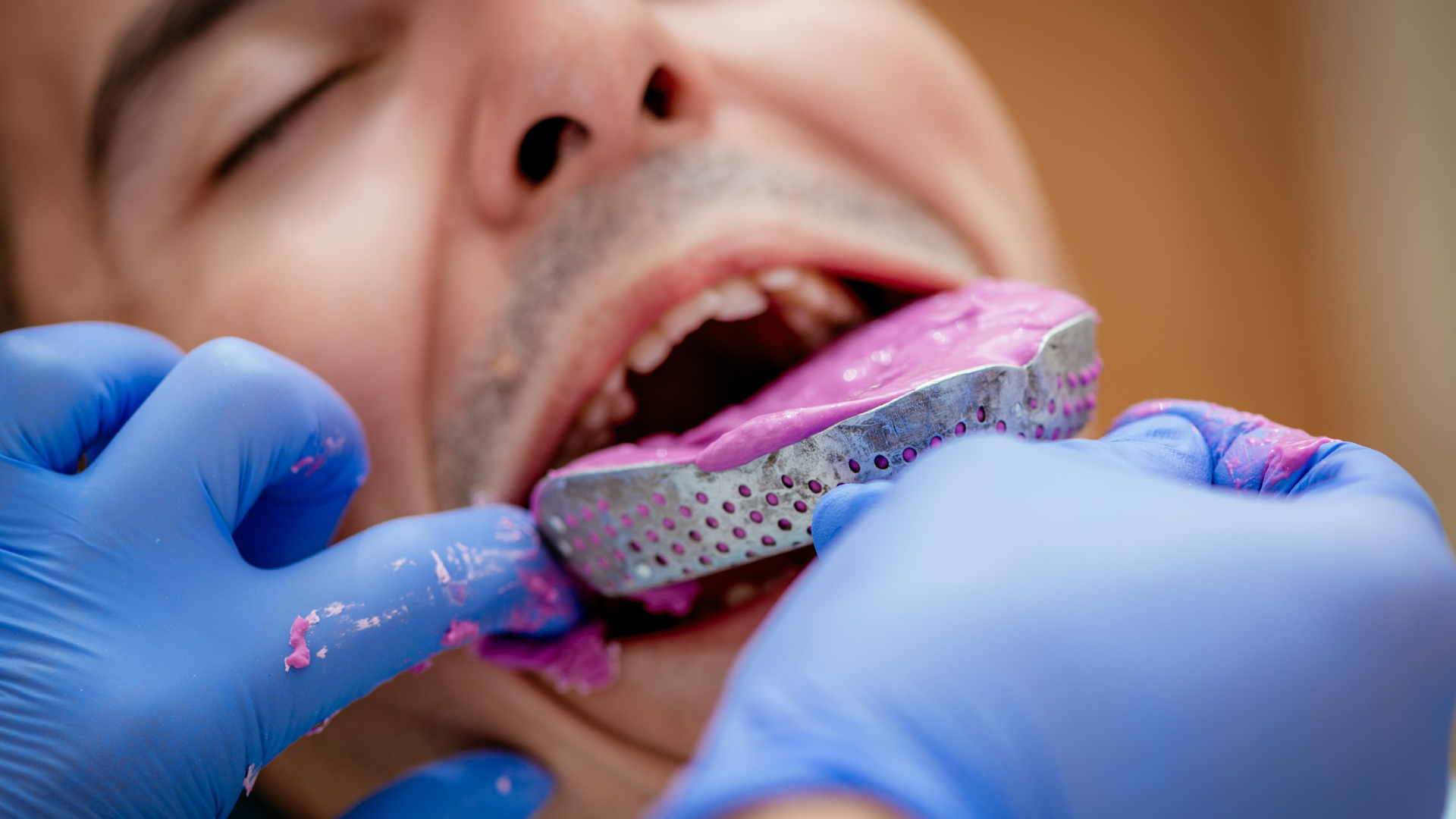 Alternatives to Dental Implants: A Comparison of Costs, Pros and Cons