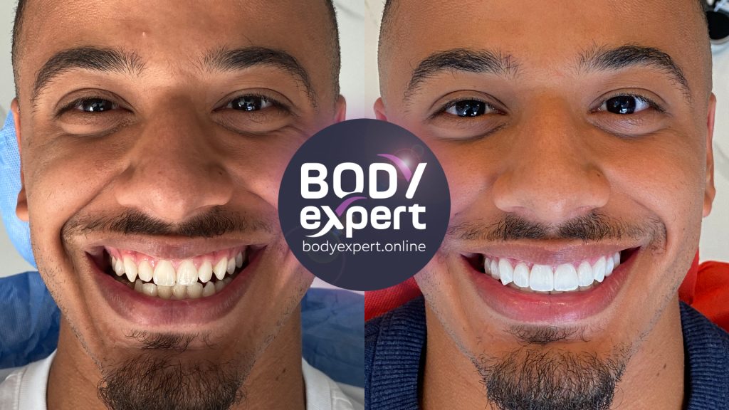 #Turkey Teeth: The Real Story Behind Dental Procedures in Turkey