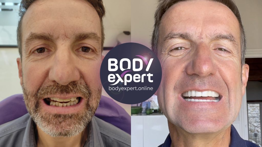 #Turkey Teeth: The Real Story Behind Dental Procedures in Turkey