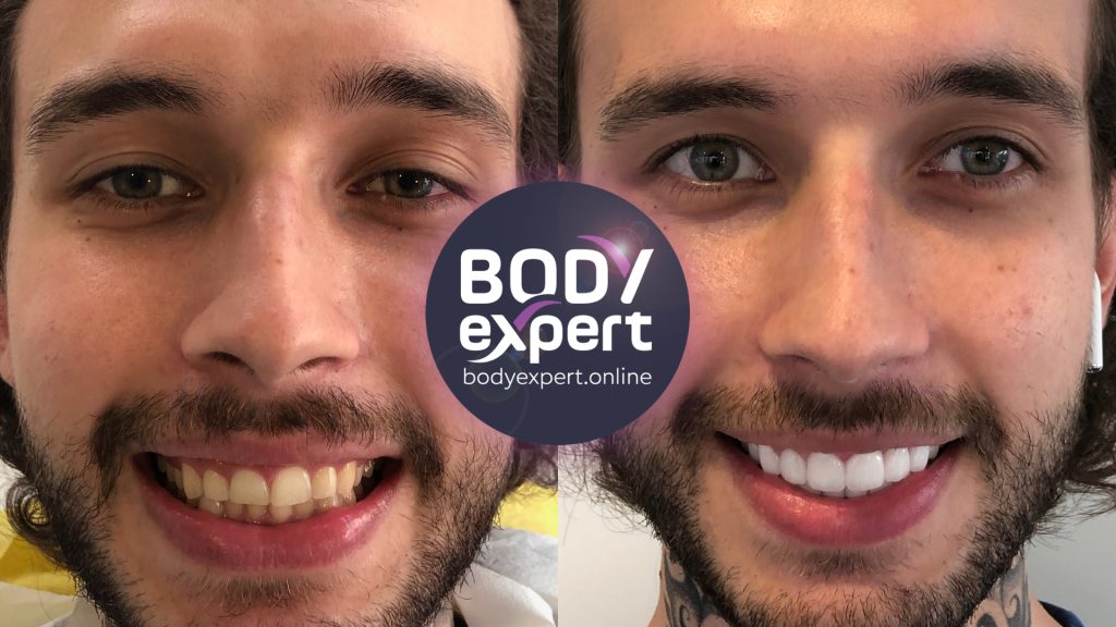 #Turkey Teeth: The Real Story Behind Dental Procedures in Turkey