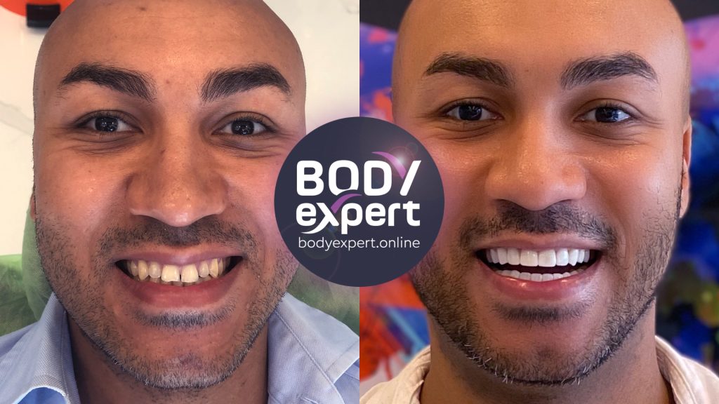 #Turkey Teeth: The Real Story Behind Dental Procedures in Turkey